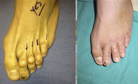 Best Podiatrist Nyc Foot Doctor Nyc City Footcare Nyc