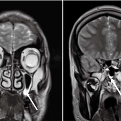 A Ostiomeatal Complex Patency Where Both The Right And Left Sides Are