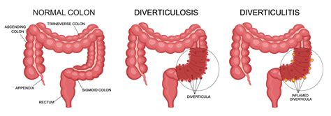 Understanding Diverticulitis Flare Ups Triggers And Remedies Calming Blends