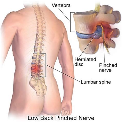 Herniated Disc Causes Symptoms Diagnosis Treatment And Prognosis
