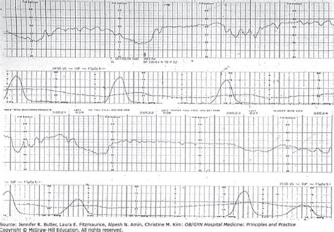 Electronic Fetal Heart Rate Monitoring For The Ob Gyn Hospitalist