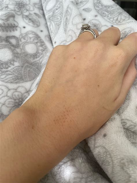 Non Blanching Rash R Doctorswithoutborders