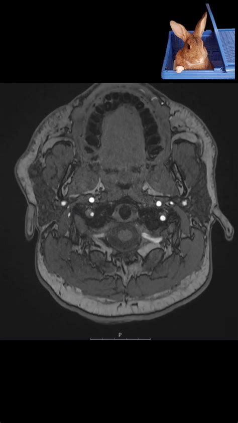 Type 2 Aica Loop R Radiology