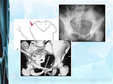 Pelvic Fracture Classification Pptx