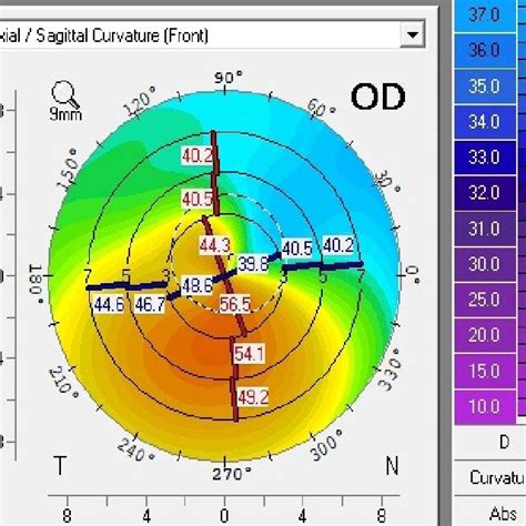Corneal Topography Demonstrating Regular Astigmatism Download