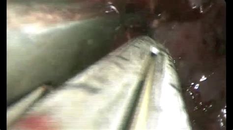 Uniportal Lobectomy For Cystic End Stage Bronchiectasis Youtube