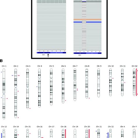 Choroid Plexus Atypical Papilloma Molecular Features A Integrative Download Scientific