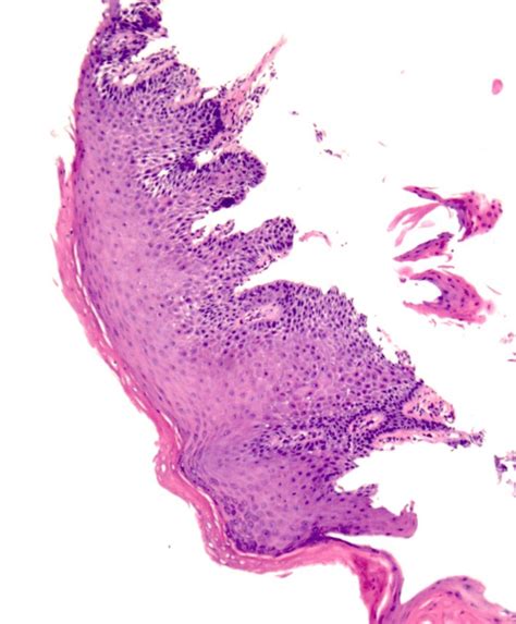 Diffuse Esophageal Hyperkeratosis A Rare Case Presentation Pmc