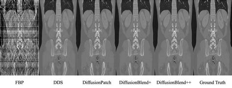Generative Ai Model Can Reconstruct 3d Medical Imaging With Much Lower X Ray Dose