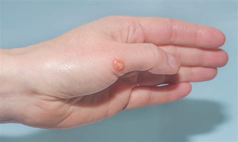 ตุ่มใสที่นิ้ว สาเหตุ อาการและการรักษา Hello Khunmor