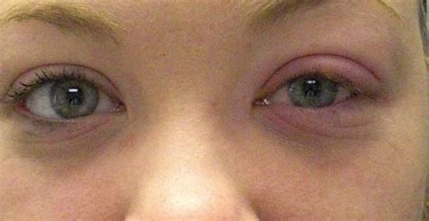Stye Diagnosis And Treatment In Elmhurst Il Skowron Eye Care