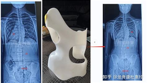 脊柱侧弯患者佩戴不合格的支具一年时间增加了12度 知乎