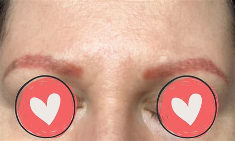 68 Best R Microbladingremoval Images On Pholder Nearly Finished With Tattoo Removal