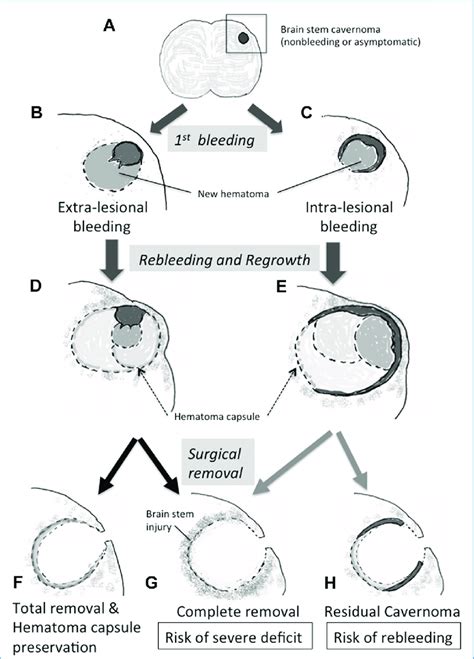 A Schematic Drawing Of The Cavernoma Structure B And C The