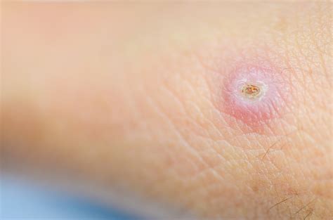 Mrsa Adalah Penyakit Id