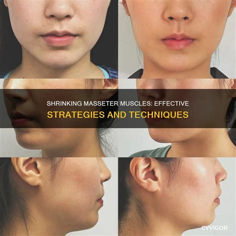 Shrinking Masseter Muscles Effective Strategies And Techniques Cyvigor