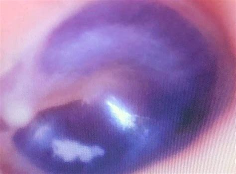 Doctor Sunithas Blog White Patch On The Ear Drum What Is It