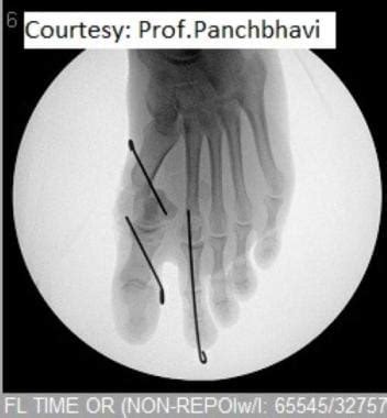 Hallux Valgus Osteotomy Technique Approach Considerations Chevron