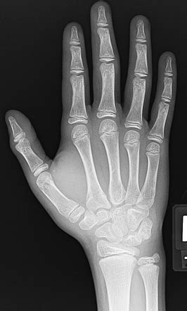 St Metacarpal