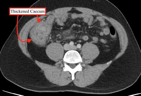 Interestingcase Ct Appendix Caecum Operativefindings Appendix Appendix Caecum Appendix