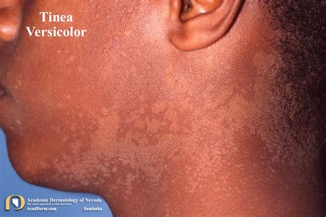 Tinea Versicolor Symptoms Causes Treatments Atelier Yuwaciaojp