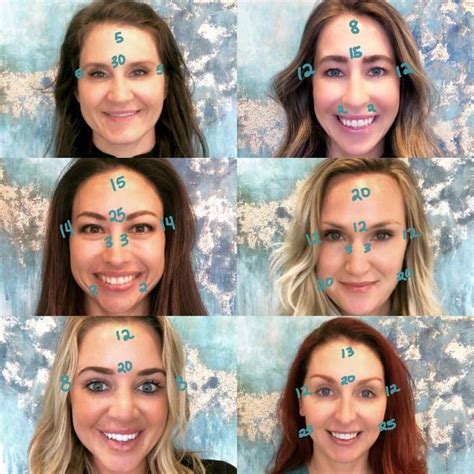 Botox Dosing Why Its Important To Properly Dose Beyond Aesthetics