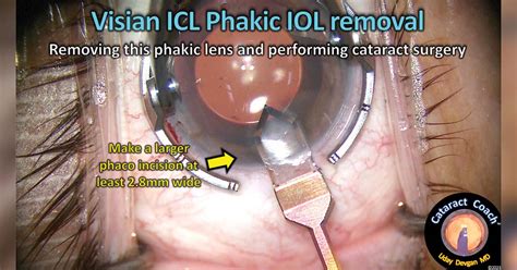 Cataract Extraction With Intraocular Lens Icd 10 At Louise Rizo Blog