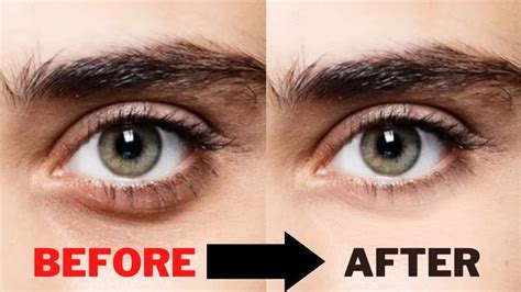 How To Remove Eye Bags And Dark Circles Without Losing Any Texture In