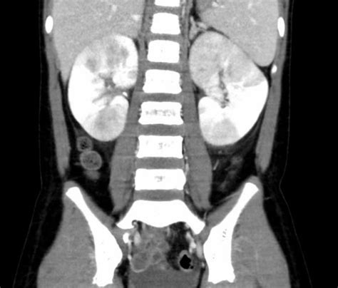 Nephronia Treatment Does Acute Lobar Nephronia Relieve With
