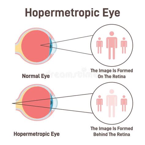 Hypermetropic Astigmatism Hyperopic Eye Vision With Comparison Stock