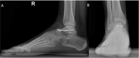 Perfect Reduction And Fixation Of The Talar Neck With Reduced Download Scientific Diagram