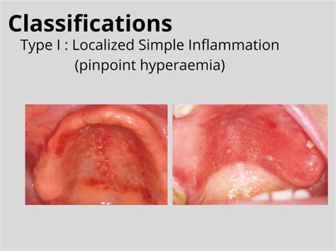 Removable Prosthodontics Denture Stomatitis Pdf