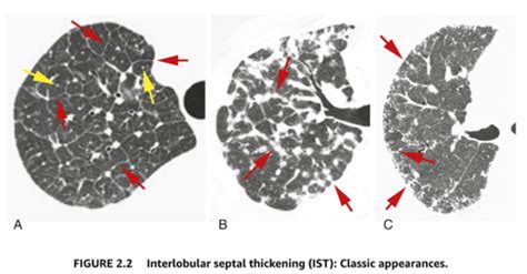 Chapter 2 Reticular Opacities Flashcards Quizlet