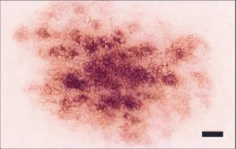 Multifocal Hyperpigmented And Hypopigmented Type Of Clark Nevus Scale