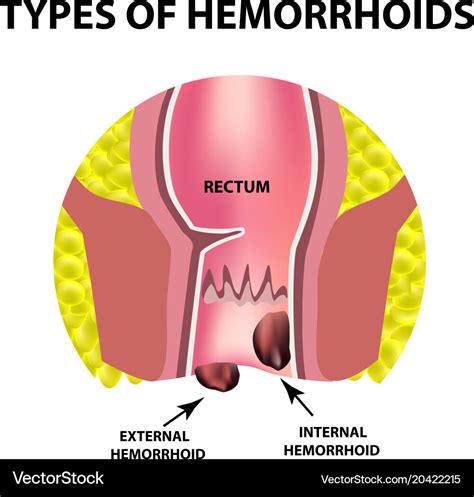 Two Types Of Hemorrhoids Are External And Internal