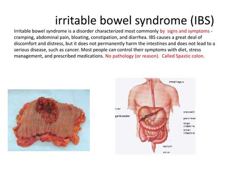 PPT Appendicitis Inflammation Of The Appendix From A Blockage PowerPoint Presentation ID