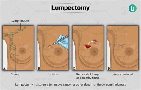 Lumpectomy Procedure Purpose Results Cost Price