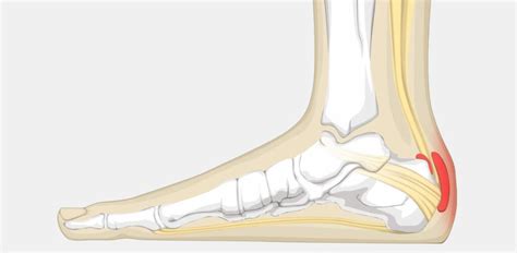 Goodbye Heel Pain Retrocalcaneal Bursitis Relief Guide Osteomag