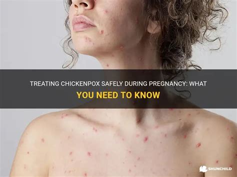 Treating Chickenpox Safely During Pregnancy What You Need To Know