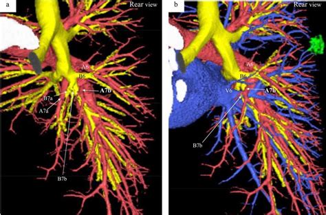 Three Dimensional Ct Angiography And Bronchography Images A Download Scientific Diagram