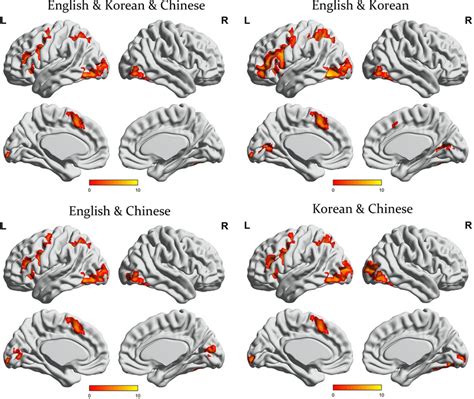 Overlap Of Activated Brain Regions Between Languages Download