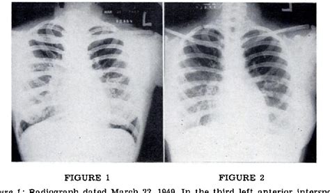 Figure 3 From Mucocele Of The Lung Due To Congenital Obstruction Of A Segmental Bronchus A Case