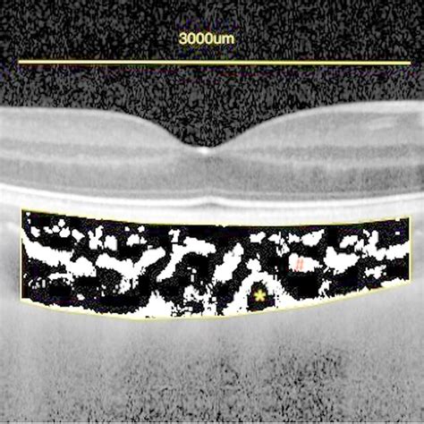 Enhanced Depth Imaging EDI OCT Image And Converted Binary Image Of A