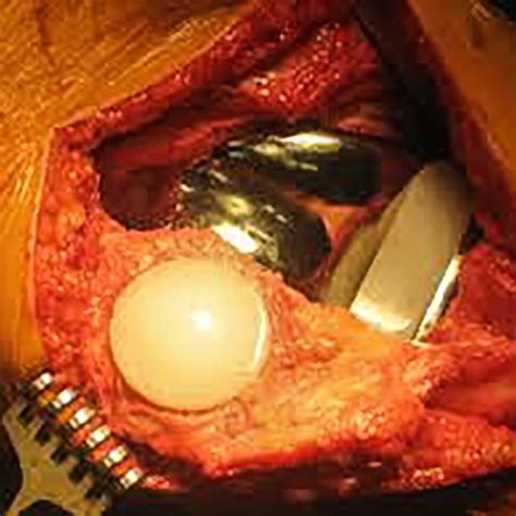 Insertion Of Patellar Component For Patellar Resurfacing Download