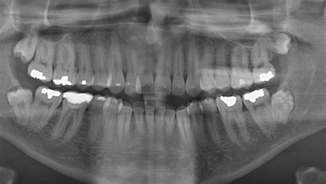 Teeth Identification Object Detection Dataset By SAEED ALQARNI