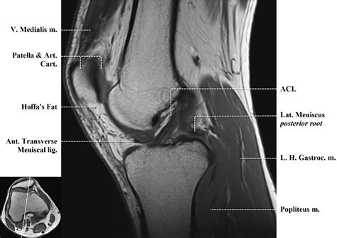 Knee Joint Mri Anatomy Lateral Meniscus Of Knee Joint Complete