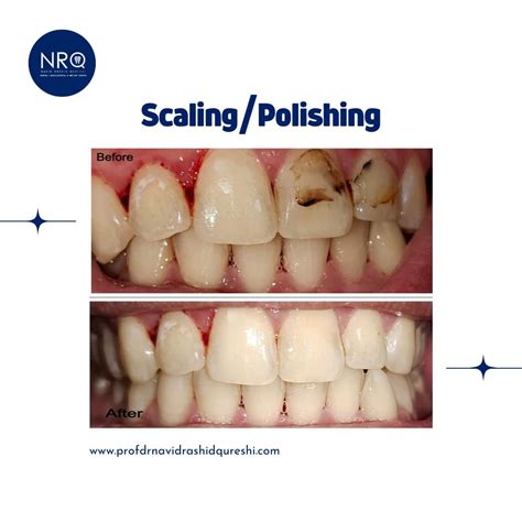 Scaling And Polishing Vs Cleaning At Landon Artis Blog