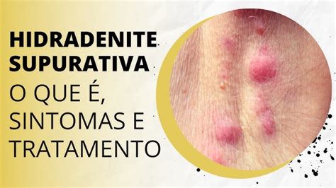 Cura Para Hidradenite Supurativa Nossa Pele Hs Perder Peso Pode