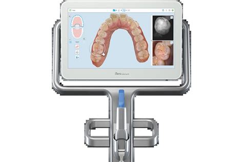 Itero Intraoral Scanner Inglewood California Blue Diamond Dental