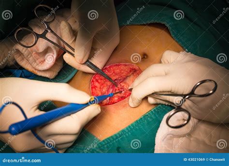 Appendectomy Royalty Free Stock Image 55316020